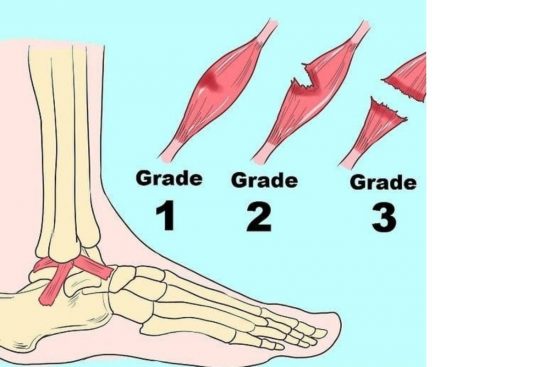 Sprained Ankle? Why Physiotherapy Is The Best Treatment - Thrive Physio ...